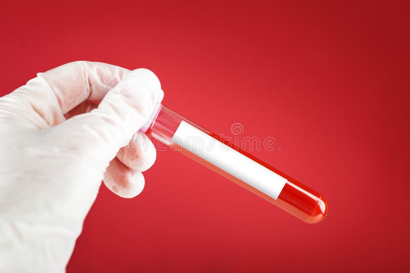 Hand Holding Test Tube with Blood Plasma Ready for Testing. Medicine ...