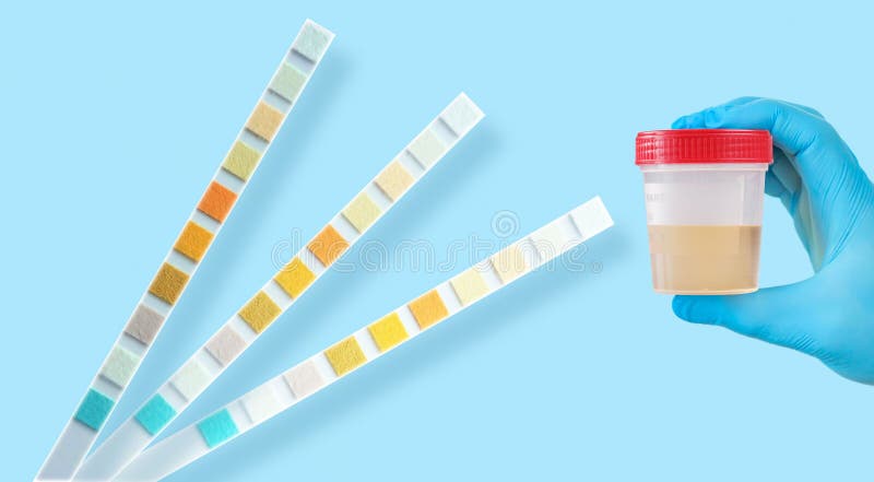 Urinalysis, Urine Cup with Reagent Strip PH Paper Test and Comparison ...