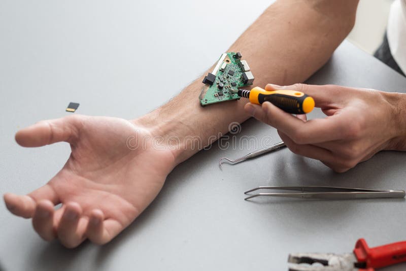 Hand with Implantation of Micro Chip. X-Ray View Close-up. Chipization ...