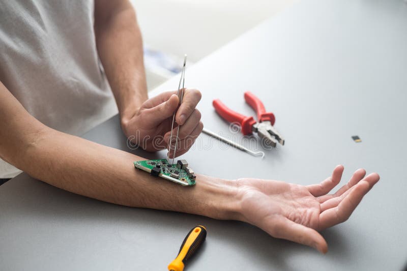 Hand with Implantation of Micro Chip. X-Ray View Close-up. Chipization ...