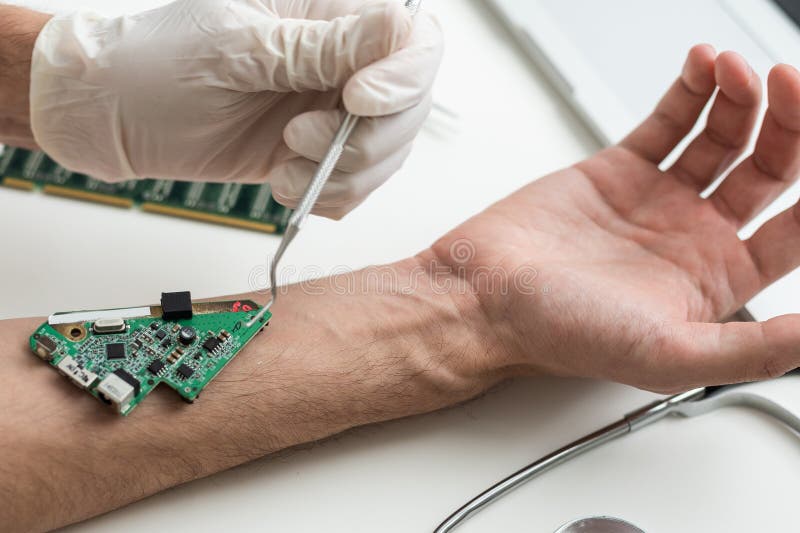 Hand with Implantation of Micro Chip. X-Ray View Close-up. Chipization ...