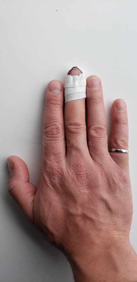 Hand injury and ring stock image. Image of safety, healing - 182525415