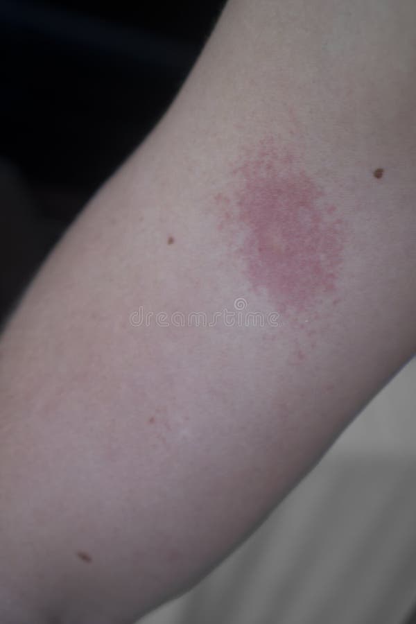 Hand with insect bite stock image. Image of dangerous - 100078687