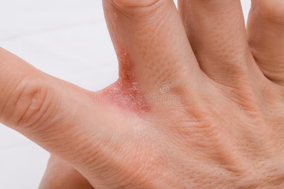 Hand with Interdigital Dermatitis, Dyshidrotic Eczema on Hand Close Up ...