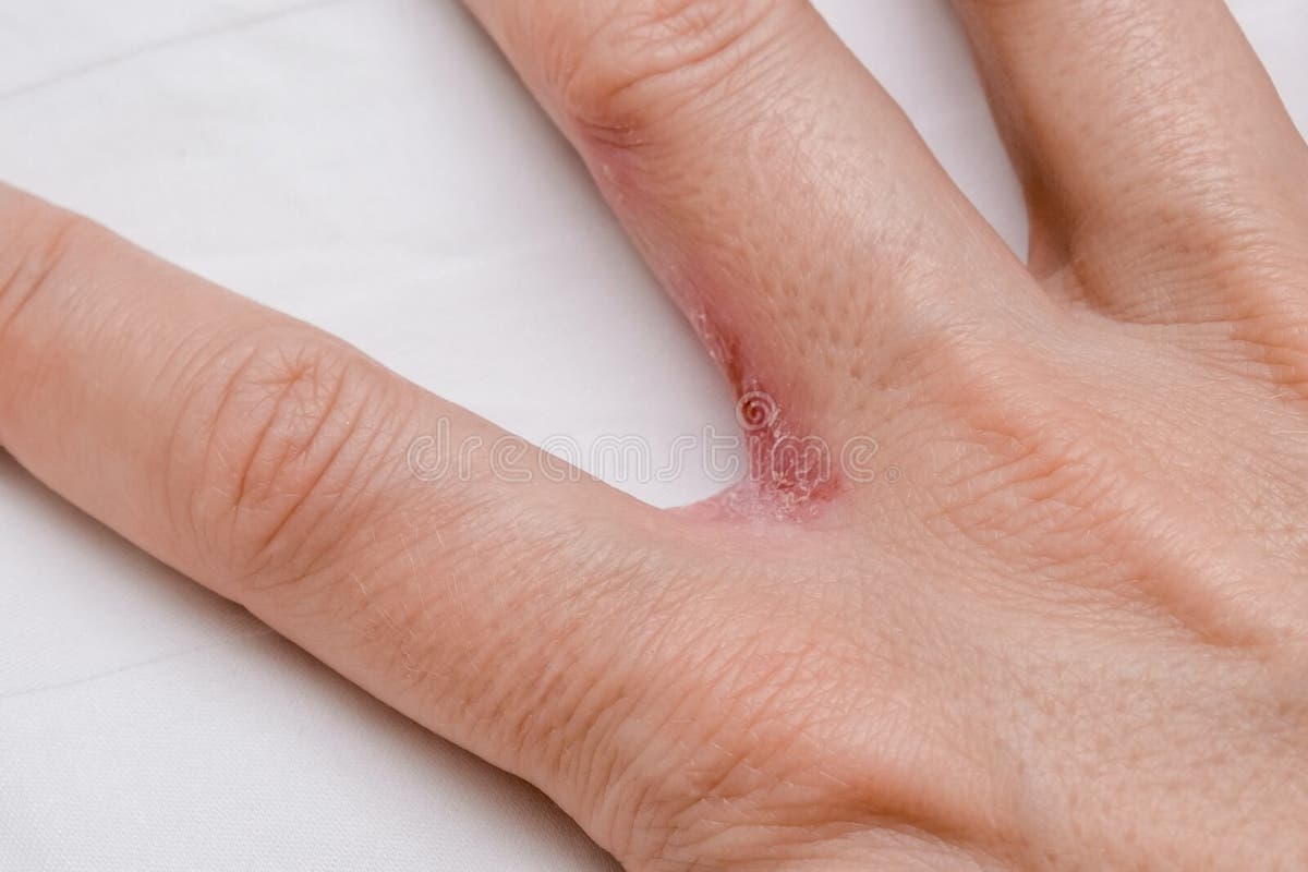 Interdigital Dermatitis Stock Photos - Free & Royalty-Free Stock Photos ...