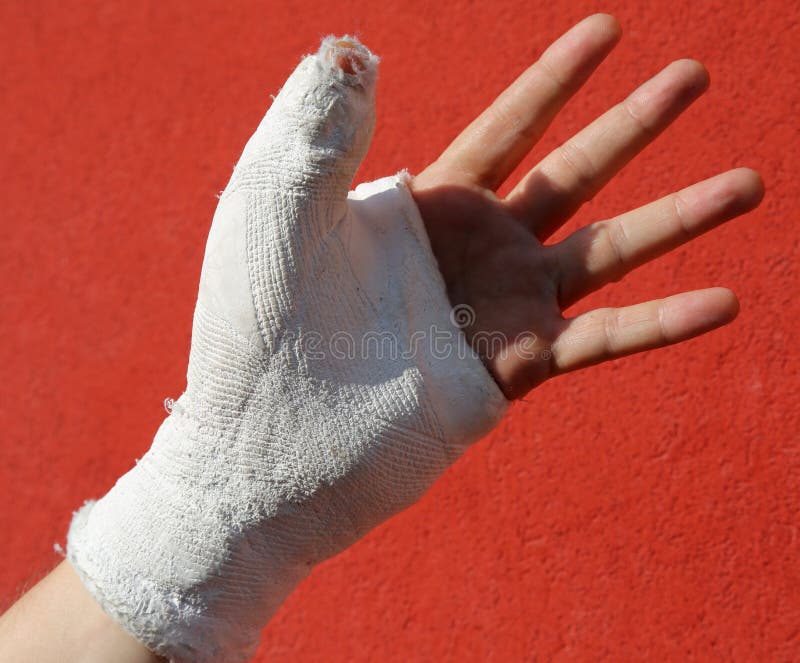 Übergeben Sie Und Der Gipsabdruck am Krankenhaus Mit Dem Daumen Oben ...