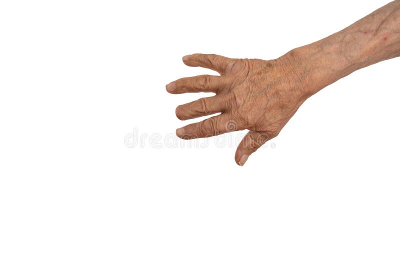 Hand of an Old Man with a Missing Middle Finger Phalanx on the White ...