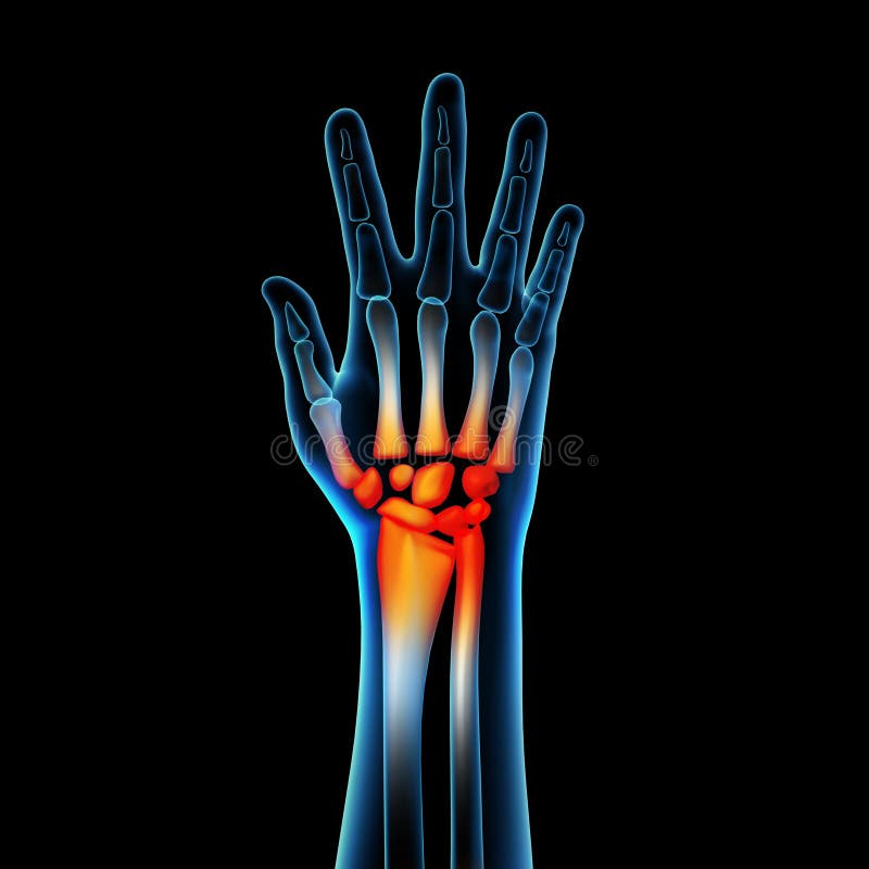 Painful hand stock illustration. Illustration of arthritis - 2463443