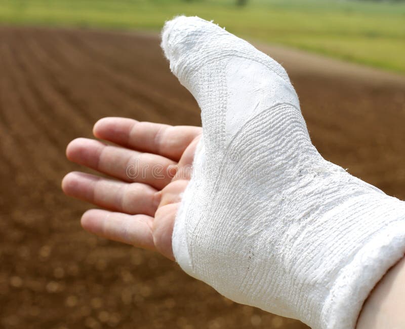 Hand Plaster Especially the Thumb Stock Image - Image of bandage, rift ...