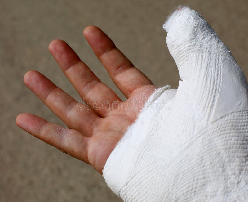 Hand Plastered after a Fracture Stock Photo - Image of care, people ...