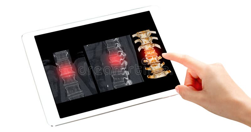 .a Hand Points at a Tablet Screen Showing a CT Scan of the Lumbar Spine ...