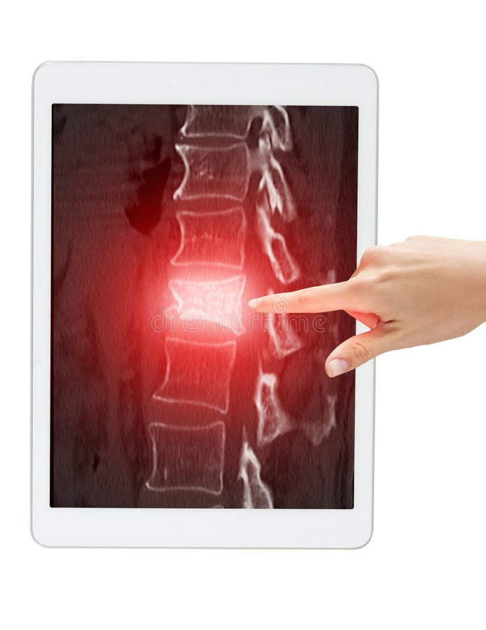 .a Hand Points at a Tablet Screen Showing a CT Scan of the Lumbar Spine ...