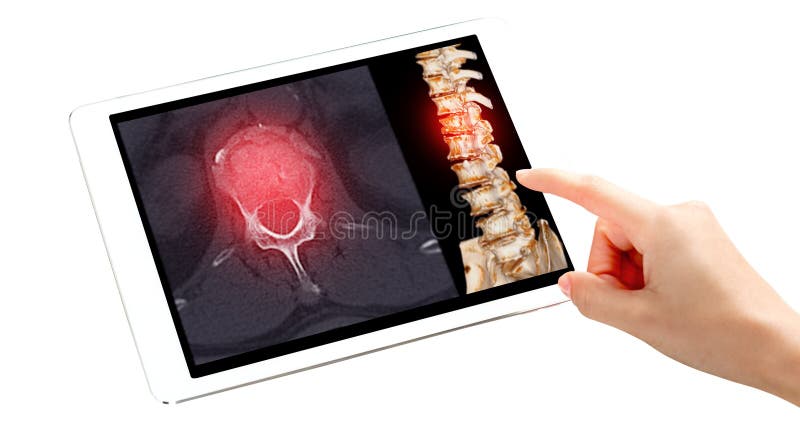 .a Hand Points at a Tablet Screen Showing a CT Scan of the Lumbar Spine ...