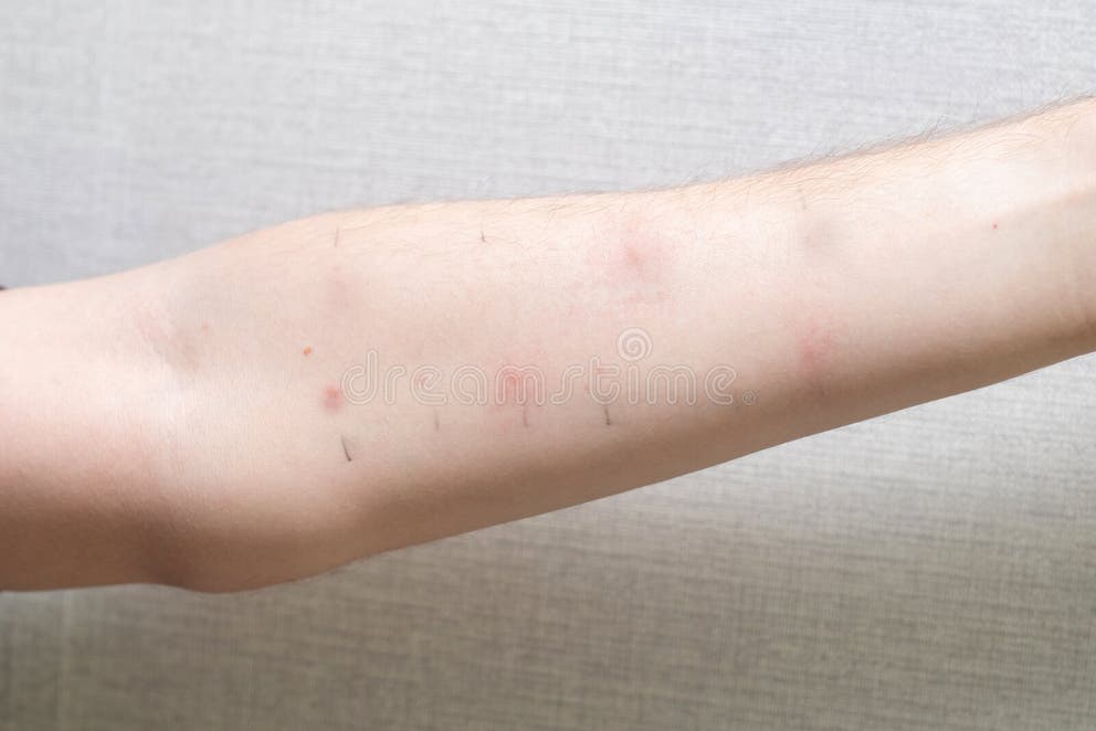 Hand with Positive Allergy Tests. Allergy Tests on the Arm Stock Image ...