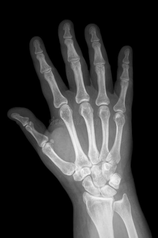 Hand x-ray stock photo. Image of body, bones, anatomy - 15325754