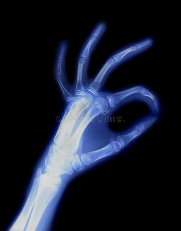 Hand X-ray stock image. Image of roentgen, medical, test - 4352911