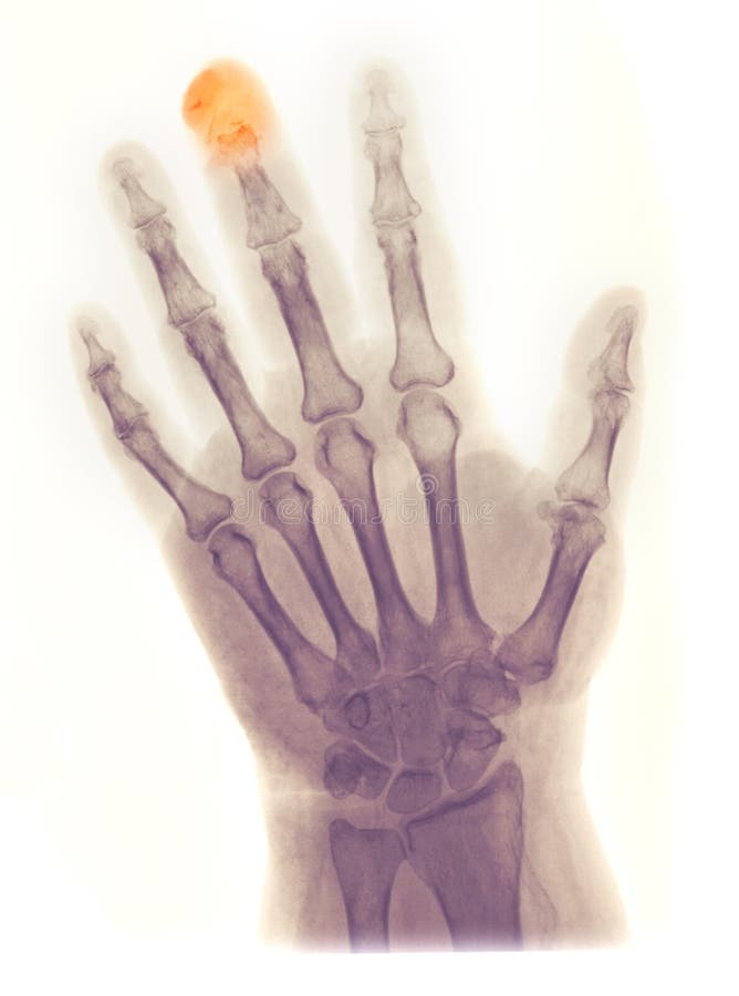 Missing Distal Phalanx