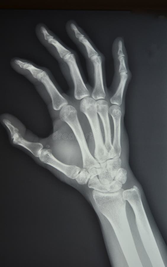 Hand X-ray stock photo. Image of palm, anatomy, human - 34392530