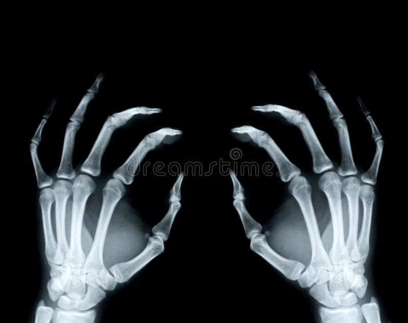 Hand X-ray rphotograph stock photo. Image of skeleton - 28007314