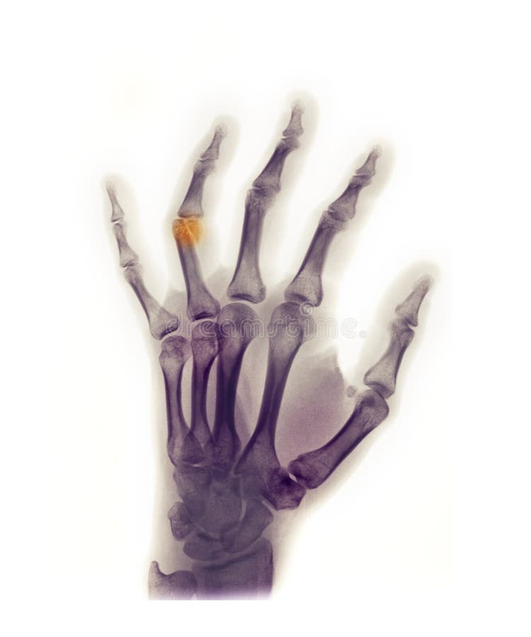 Dislocated Finger X Ray