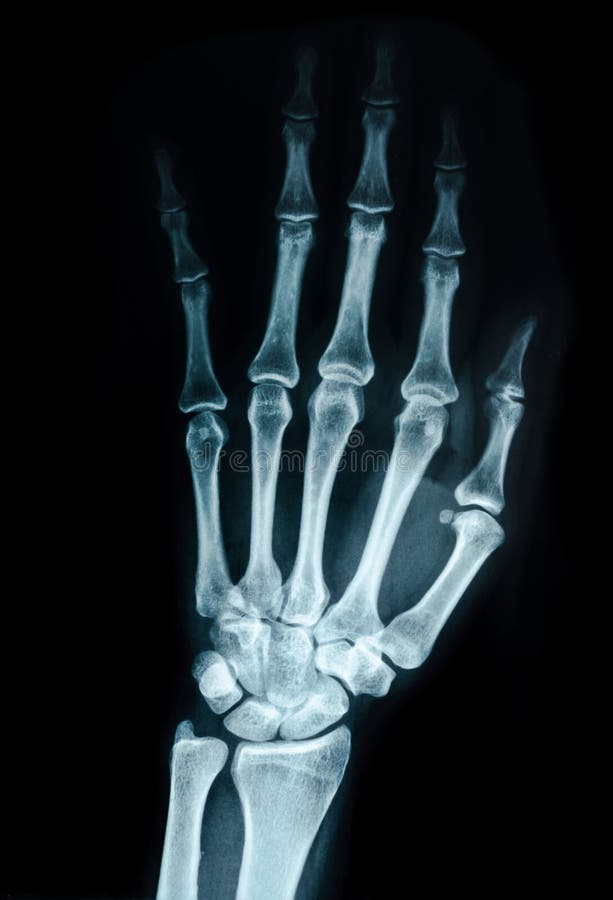Hand x-ray view. stock photo. Image of medical, hand - 99024952