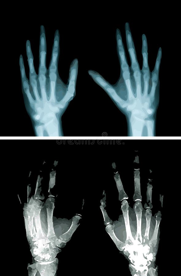 Hand x-rays stock vector. Illustration of arthritis, rheumatism - 6211898
