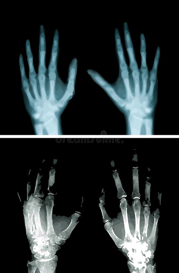 Hand x-rays stock vector. Illustration of arthritis, rheumatism - 6211898