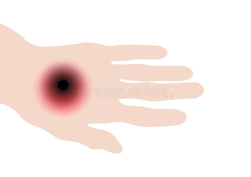 Hand with Red, Cutaneous Anthrax Skin Lesion Featuring Dark Center ...