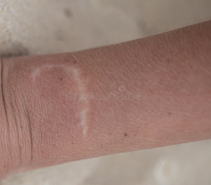 The hand with the scar stock image. Image of appendicitis - 170800811