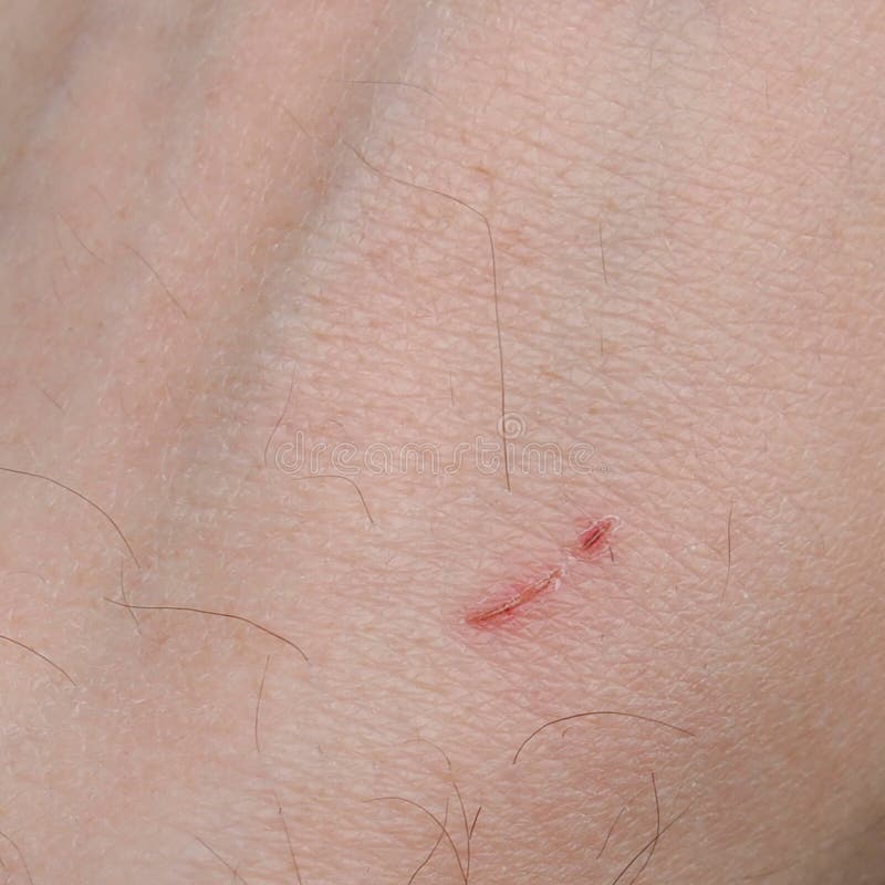 Hand scar stock image. Image of wound, scar, hand, accident - 40247351