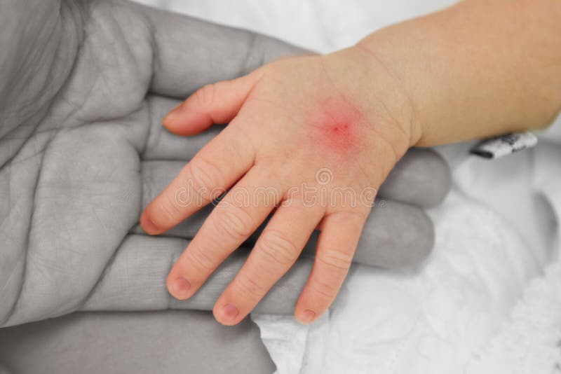 Hand of Sick Baby with Tracks Injection ( Post I .V Injection) O Stock ...