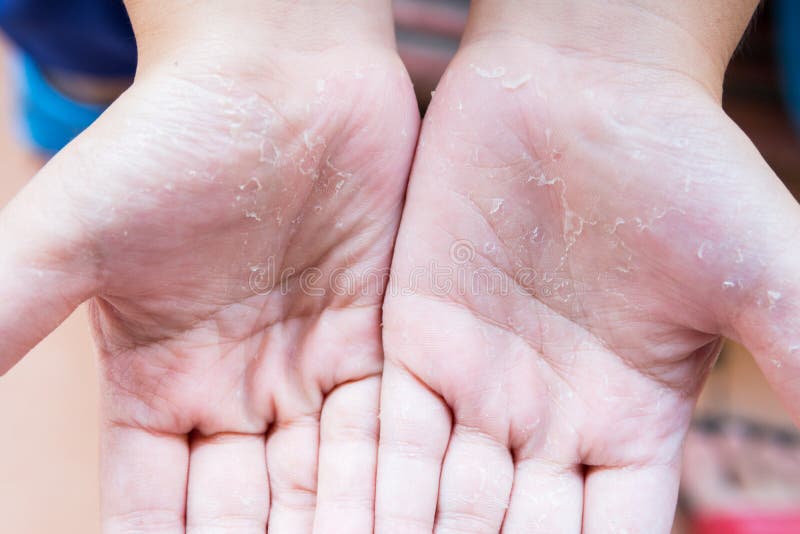 Hand skin peeling due stock image. Image of medical - 129455509