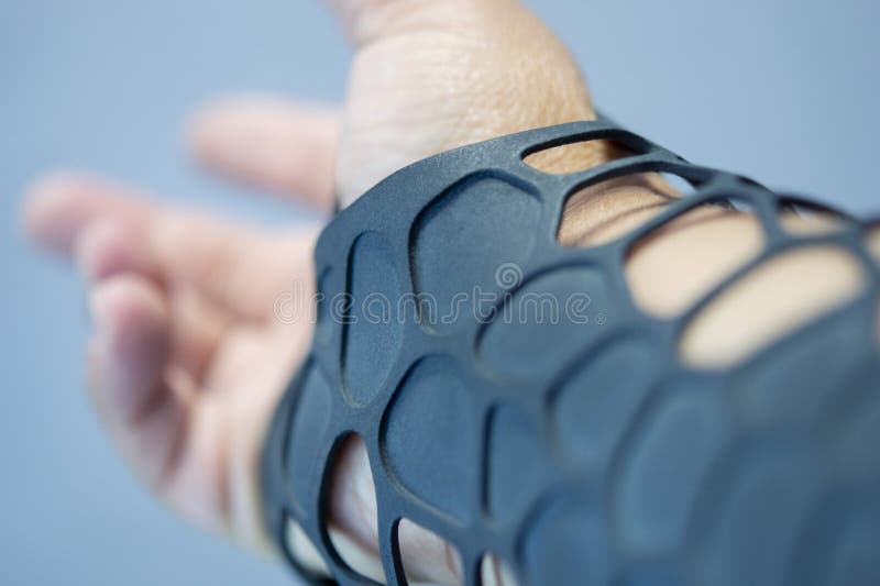 Hand Splint Corset Prosthesis Printed 3D Printer Molten Black Plastic ...