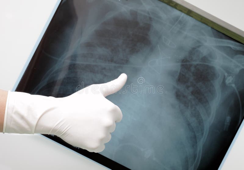 Exploding Lungs Stock Photos - Free & Royalty-Free Stock Photos from ...