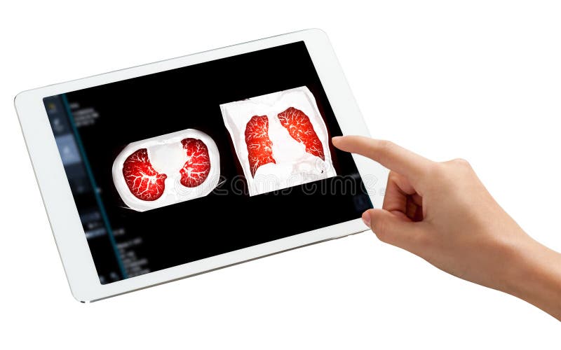 Hand Touching Tablet Display of CT Chest Scan Shown on a Tablet Screen ...