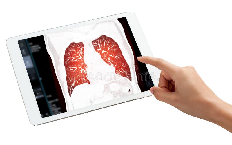 Hand Touching Tablet Display of CT Chest Scan Shown on a Tablet Screen ...