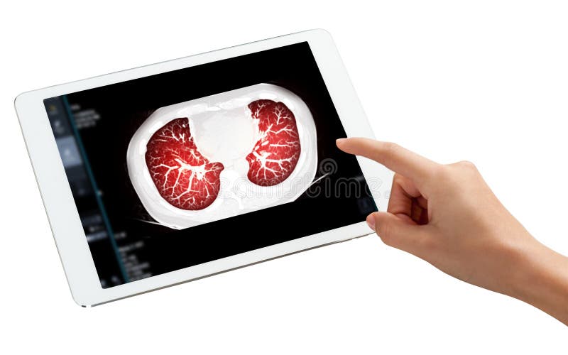Hand Touching Tablet Display of CT Chest Scan Shown on a Tablet Screen ...