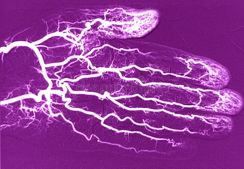 Hand Angiography, Arteriography Stock Image - Image of patient, body ...