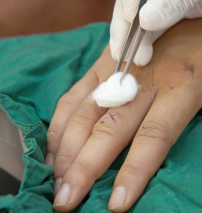 Hand Was Cut Stitch Suture. Stock Photo - Image of closeup, bandage ...
