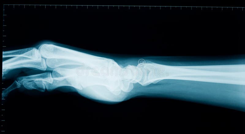 Hand wrist x-ray stock image. Image of people, bone, health - 9835513