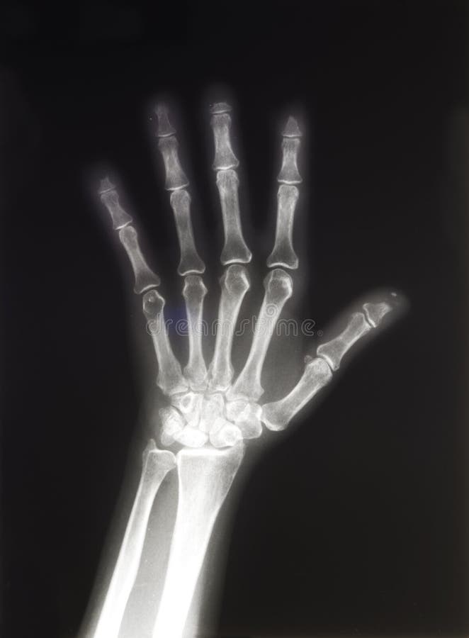 Hand X-ray Stock Photos - Image: 14395403
