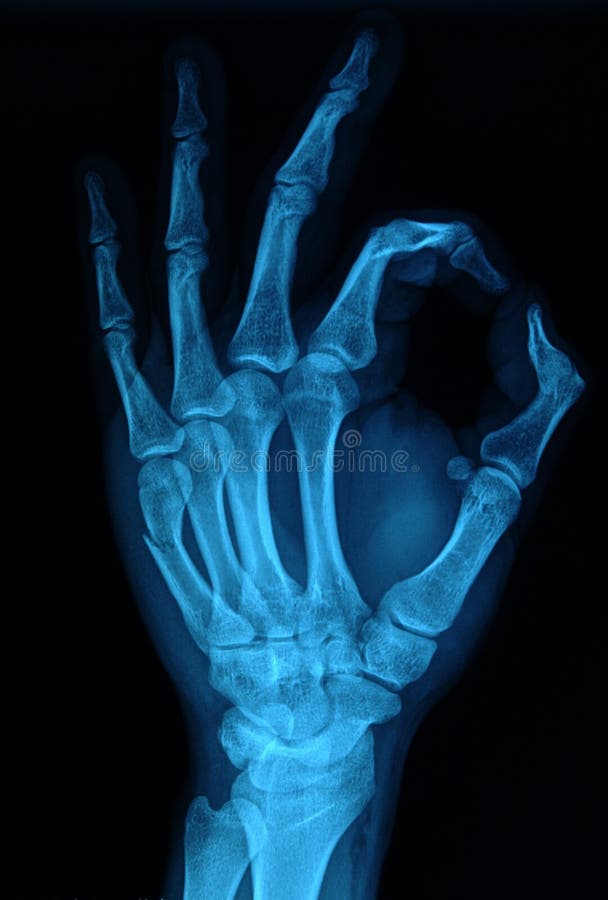 Human Adult Right Hand Bones X-ray Image. Medical and Anatomy ...