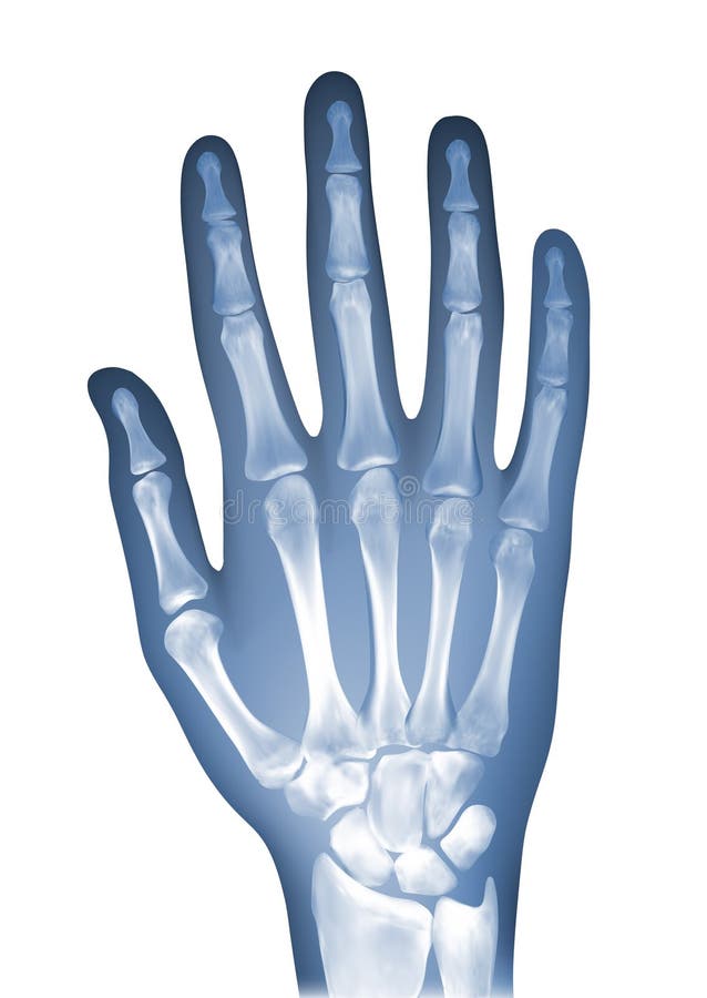 Xray Of Hand