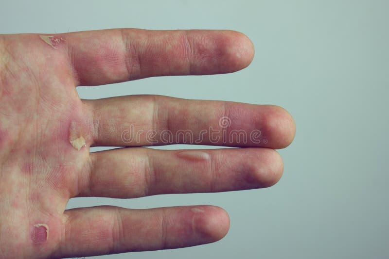 Handen Met Blaren En Eeltknobbels Stock Afbeelding - Image of sterk ...