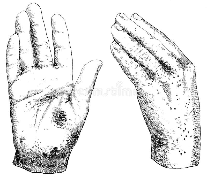 Scabies Human Stock Illustrations – 158 Scabies Human Stock ...