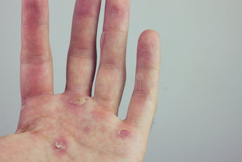 Hands with Blister and Callus Stock Photo - Image of life, chapped ...