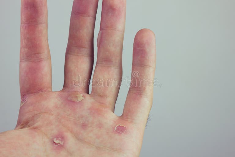 408 Finger Calluses Stock Photos - Free & Royalty-Free Stock Photos ...