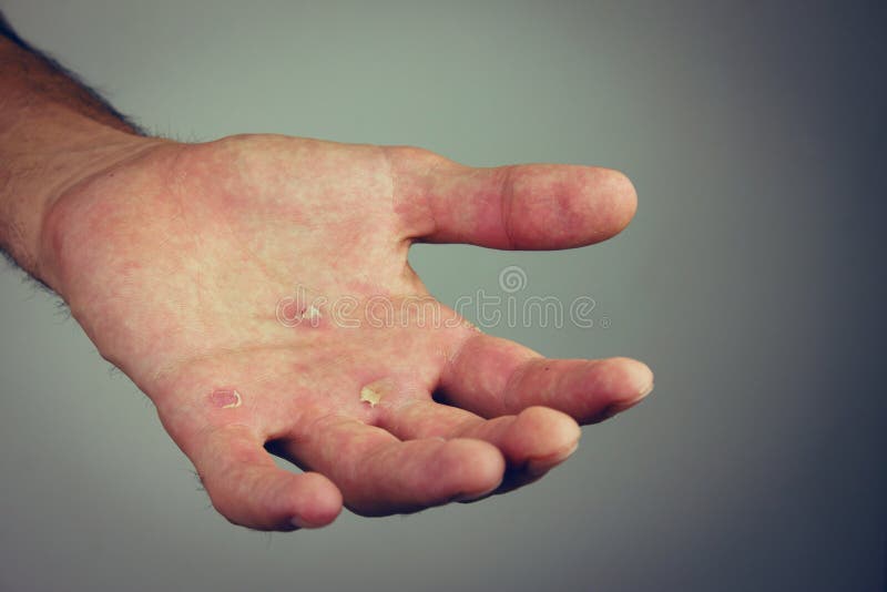 4,867 Callus Stock Photos - Free & Royalty-Free Stock Photos from ...