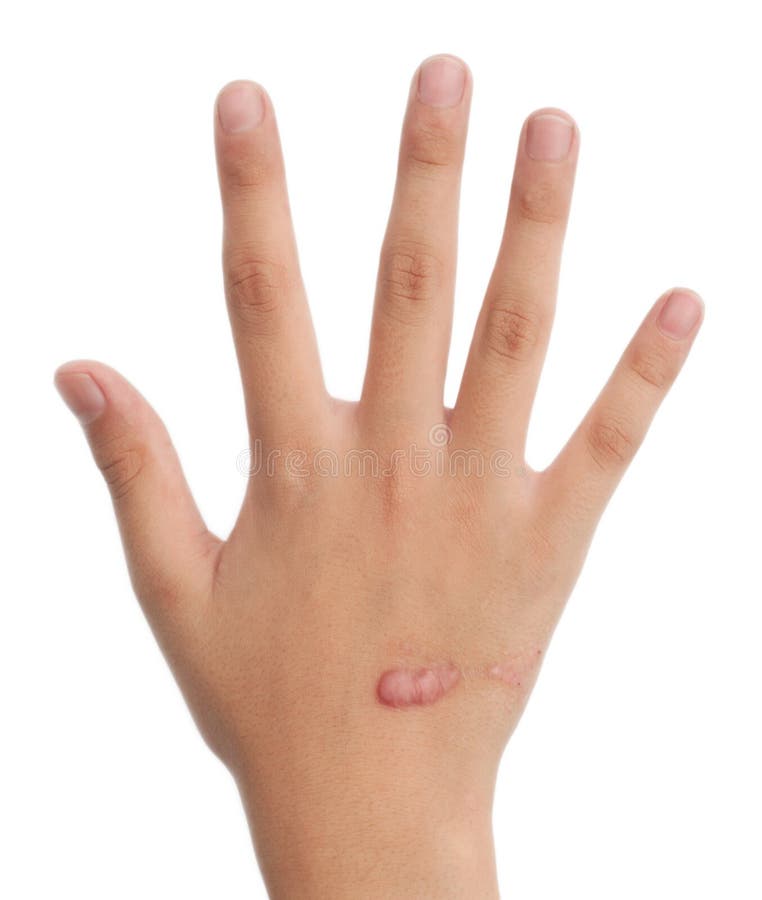 Keloid Scar Hypertrophic Scar on Man Hand Skin after Accident. Keloidal ...