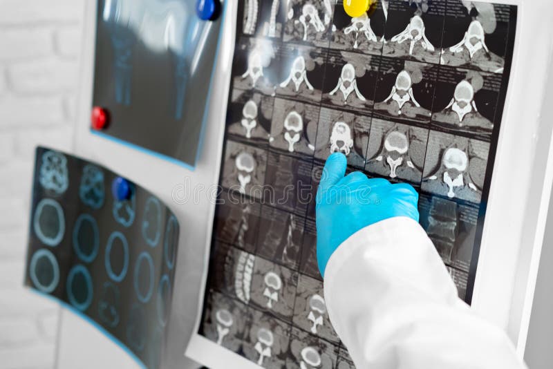 Hands of a Doctor Holding Head Mri Scan Stock Image - Image of ...